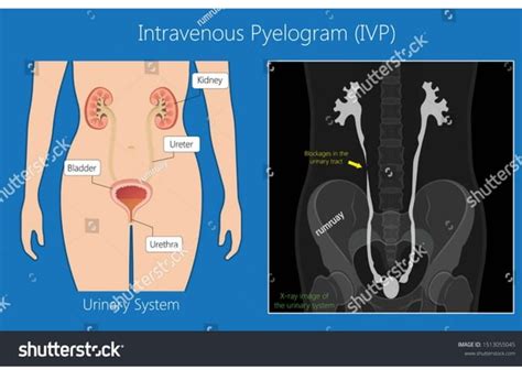 Intravenous Pyelogram Renal Tests Adults Pptx Medical Tests Medical Health