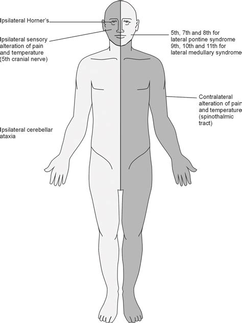 Work Out Where The Problem Is In The Brainstem Using ‘the Rule Of 4