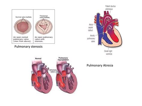 Pulmonary Valve Diseases 2 Pptx