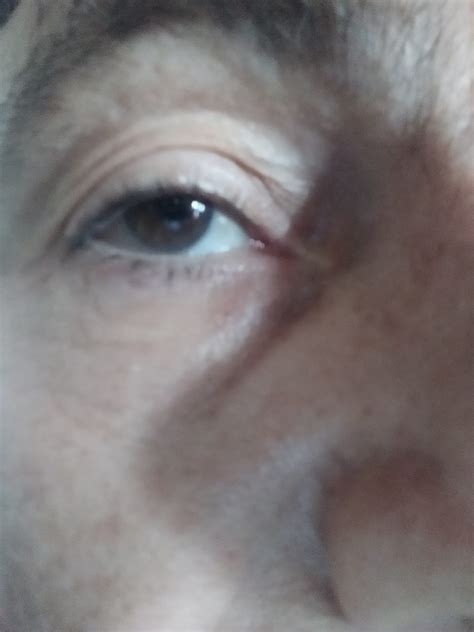 Epiblepharon Best Medical Care Service Medical Arrow Medical Tourism Experts