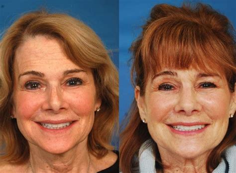 Different Parts Of A Person S Nose They Want Changes Dr Reilly