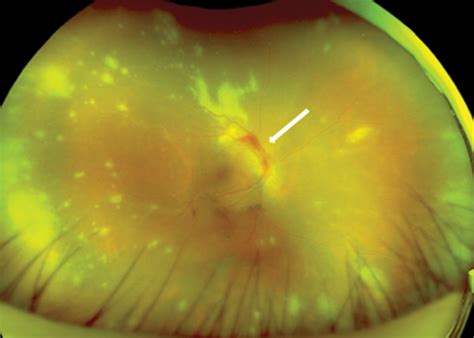 Case Of Acute Retinal Necrosis With Rapid Progression To Pro Medicine