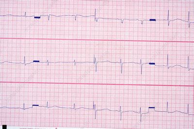 Long QT Syndrome EKG Stock Image C004 8244 Science Photo Library