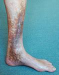 Vein Disease Stages Signs And Pictures St Louis Vein Treatment And