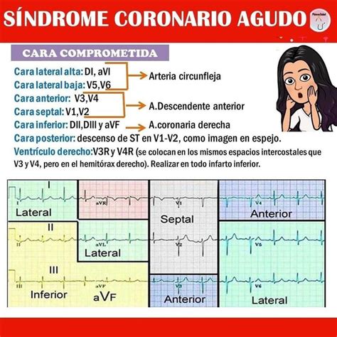 Caras Del Infarto En El Electrocardiograma