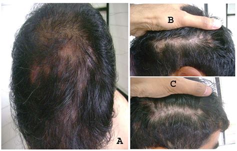 20132 8blaschkoid Our Dermatology Online