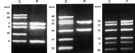 Analysis Of Dmd Gene Deletions Showing A Deletion From Exons 45 To 52