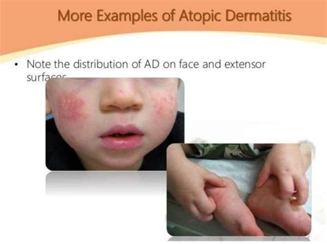 Atopic Dermatitis Immunology Ppt