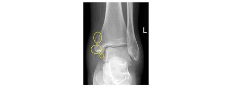 Imaging Case Of The Week 150 Answer Emergucate