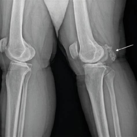 Lateral Direck Radiography Of The Left Knee Showed Irregular Calcified