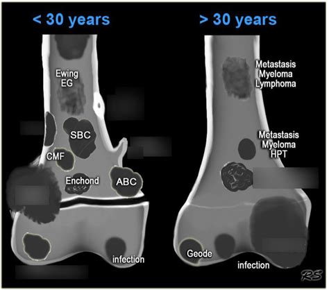 Bone Neoplasms Diagram Quizlet