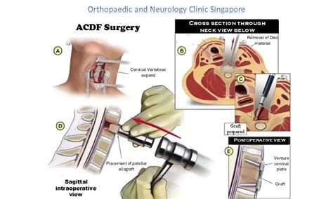 Acdf Surgery Spine Anterior Cervical Discectomy And Fusion