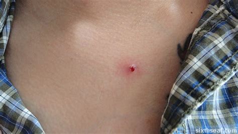 How To Remove A Dermal Piercing Caption Simple
