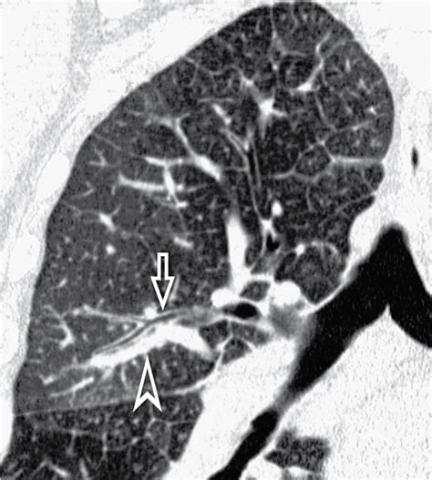 Computed Tomography Of Diffuse Lung Diseases And Solitary Pulmonary Nodules Clinical Tree