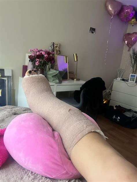 Post Fasciectomy Update Rcecompartmentsyndrome