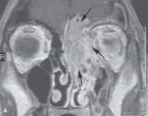 Benign And Malignant Neuroectodermal And Other Neurogenic Tumors
