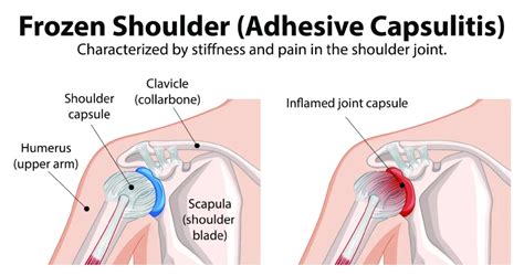 Frozen Shoulder Symptoms And Treatments Nathan Orvets Md