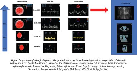 Attr Amyloidosis Gradual Progression Over 15 Years Detected On