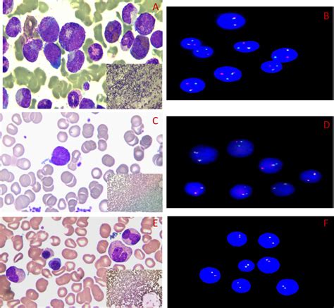 Myeloid Lymphoid Neoplasms With Etv6 Pdgfrb Fusion Gene Jir