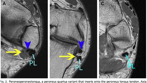 Peroneus Quartus Mri