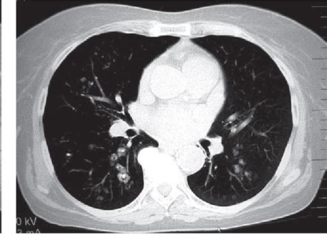 Figure 1 From Metastatic Pulmonary Calcification A Case Report And Review Of The Literature