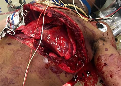 A Clamshell Thoracotomy Performed Due To A High Velocity Round To The Chest Scrolller