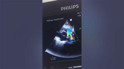 Pda Neonates Echo Neonates Neonatology Echo Youtube