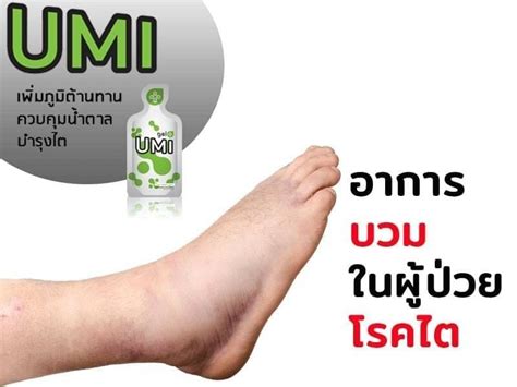 อาการ บวม ไขมัน หัวใจ ไตใกล้ตัวคุณ Facebook