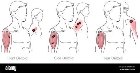 Deltoids Myofascial Trigger Points And Associated Pain Locations Stock