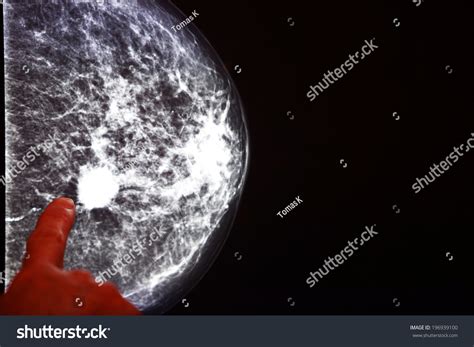 1 910件の「mammogram Image」の画像、写真素材、ベクター画像 Shutterstock