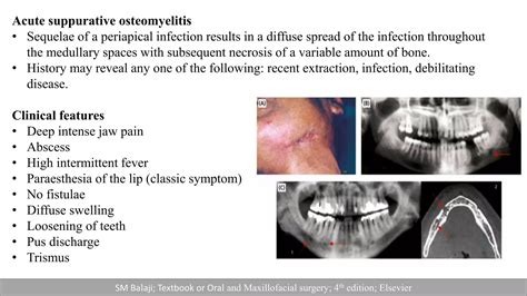 Osteomyelitis Of Jaw Pptx