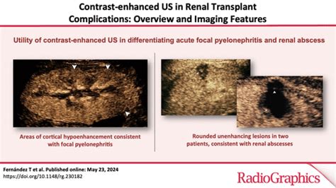 Contrast Enhanced Us In Renal Transplant Complications Overview And
