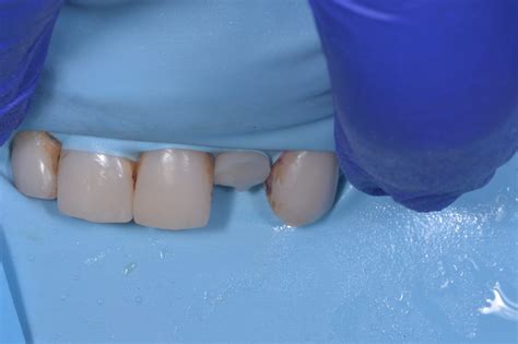 Gergis Size 1 Dme Matrix Brickworks Dental