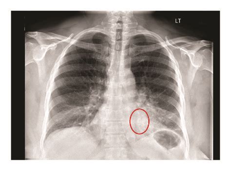 Chest X Ray Of New Infiltrative Pattern Seen In The Retrocardiac Area