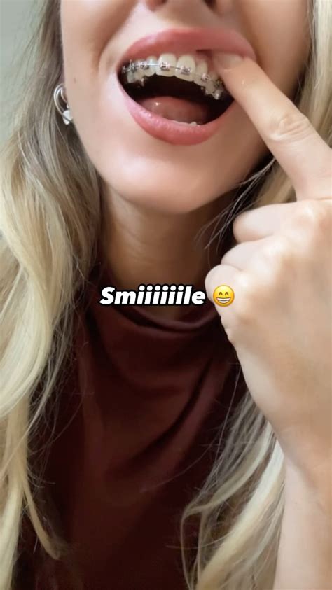 Andie Say Cheese Braces Girlwithbraces Bracessmile Braceface Orthodontist Ortho