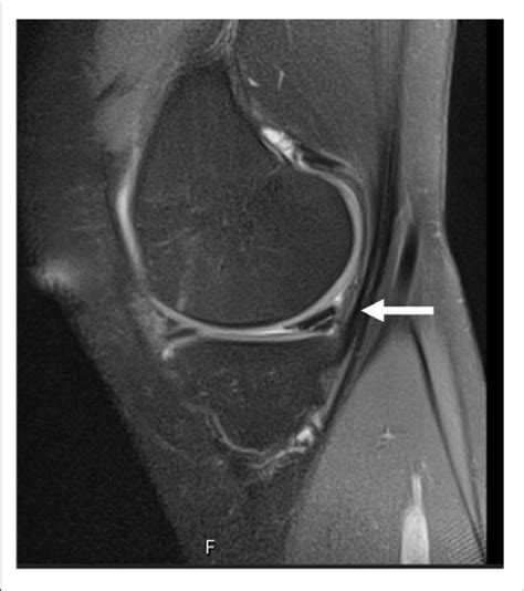 Horizontal Tear Internal Meniscus And Sagittal View Download Scientific Diagram