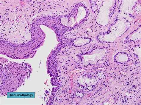 Bartholin Gland Histology Primary Villoglandular Mucinous
