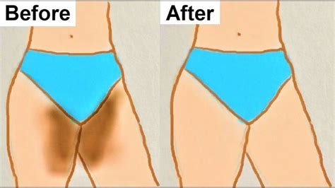 Cosmetic Gynaecology Jeewan Hospital Pusa Road
