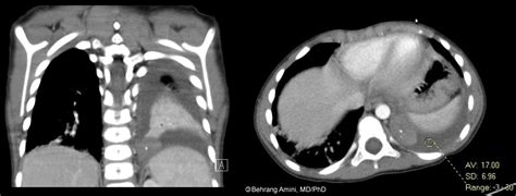 Roentgen Ray Reader Extralobar Pulmonary Sequestration With Torsion