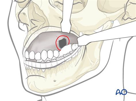 Famm Flap For Alveolar Defects In The Maxilla