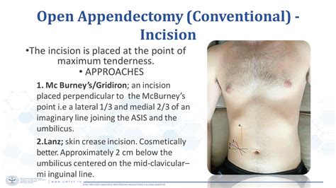 Appendectomy General Surgery Medicine Course Pdf