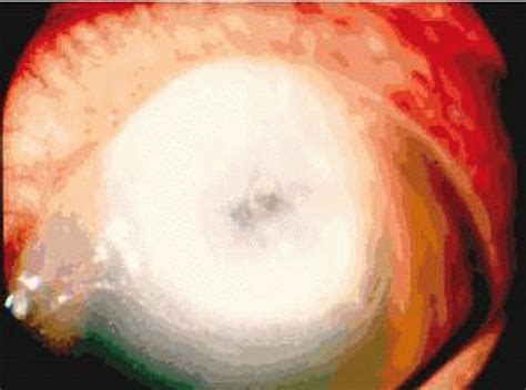 Pathogenesis Of Pseudomonas Aeruginosa Keratitis Ento Key