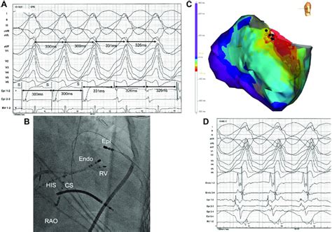 An Intracardiac Electrocardiogram Fluoroscopy And 3 Dimensional Download Scientific Diagram