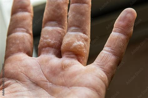 Itchy Bumps On Hands Dyshidrotic Eczema At Gerald Savage Blog