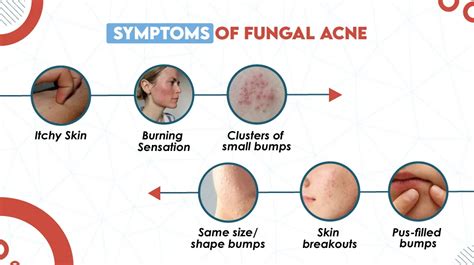 Fungal Acne Treatment A Simple Guide Happy Cappy