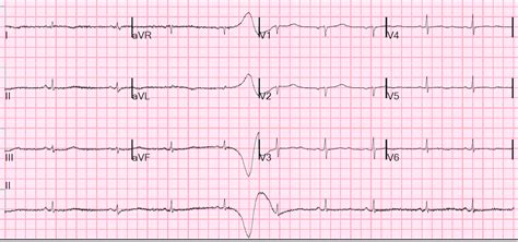 1 Hour Of Cpr Then Ecmo Circulation Then Successful Defibrillation Dr Smiths Ecg Blog