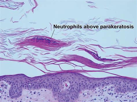 Psoriasiform And Spongiotic Dermatitis Clinical Tree