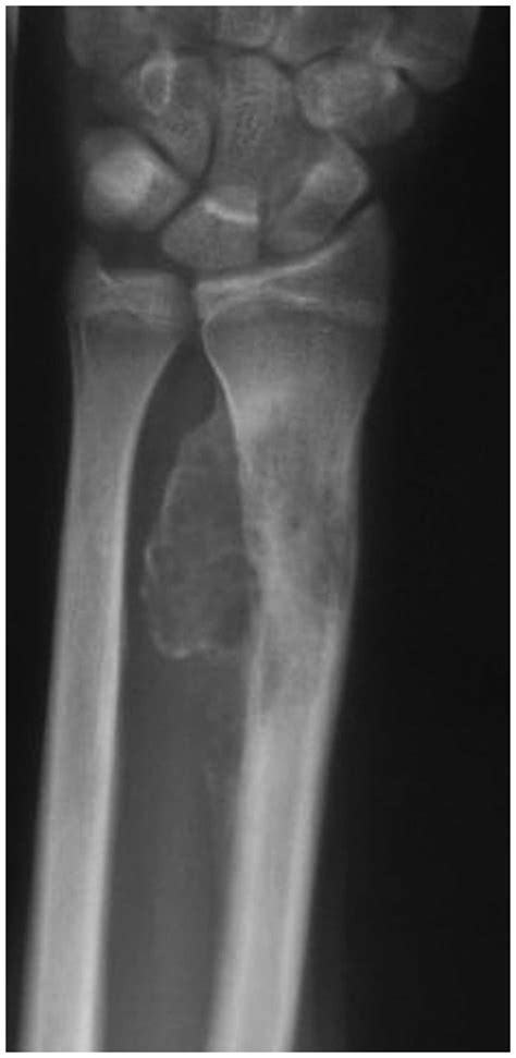 Osteosarcoma Of The Distal Radius Treated By En Bloc Resection And Reconstruction With A Fibular