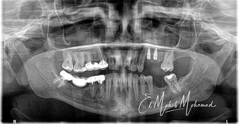 Facilitating Sinus Lifting Procedures Bone Graft And Soft Tissue