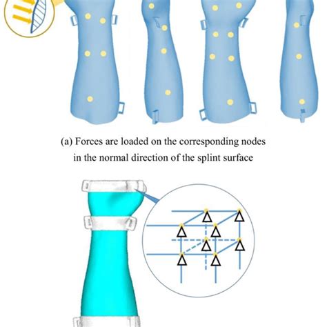 Traditional Splint For Distal Radial Fracture Download Scientific Diagram